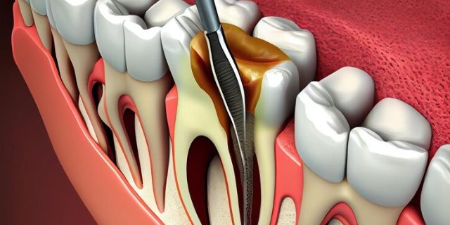 Best Cavity Formation Near Pasadena Tx 77504 - Lone Star Family Dental