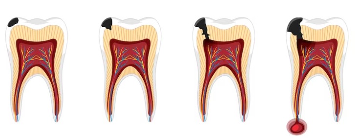 Best Cavity Formation Near Pasadena Tx 77504 - Lone Star Family Dental