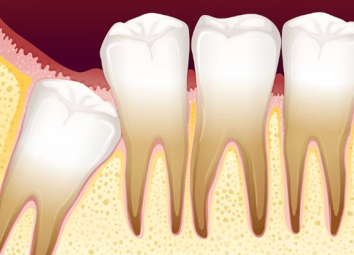 Affordable Wisdom Teeth Extraction in Pasadena 77504