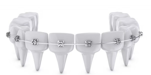 Complete Dental Brackets Near Pasadena | 77504 | Lone Star Family Dental
