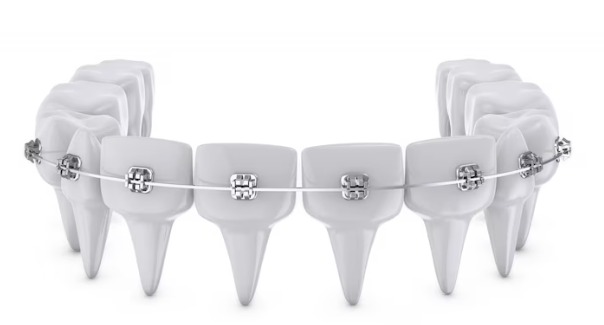 Complete Dental Brackets Near Pasadena | 77504 | Lone Star Family Dental